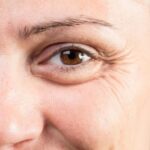 Rugas dinâmicas e estáticas - Dra. Simone Fudo | Dermatologista
