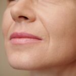 Rugas dinâmicas e estáticas - Dra. Simone Fudo | Dermatologista