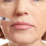 Rugas dinâmicas e estáticas - Dra. Simone Fudo | Dermatologista