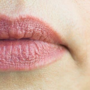 Rugas dinâmicas e estáticas - Dra. Simone Fudo | Dermatologista